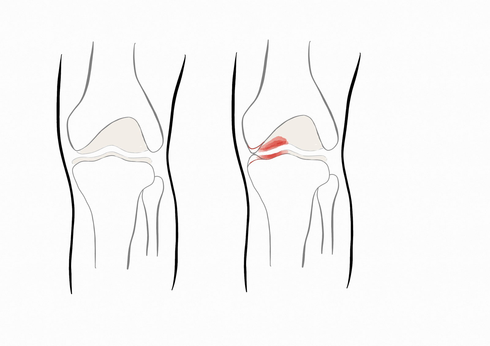 Traitement de l'arthrose de genou par embolisation de genou